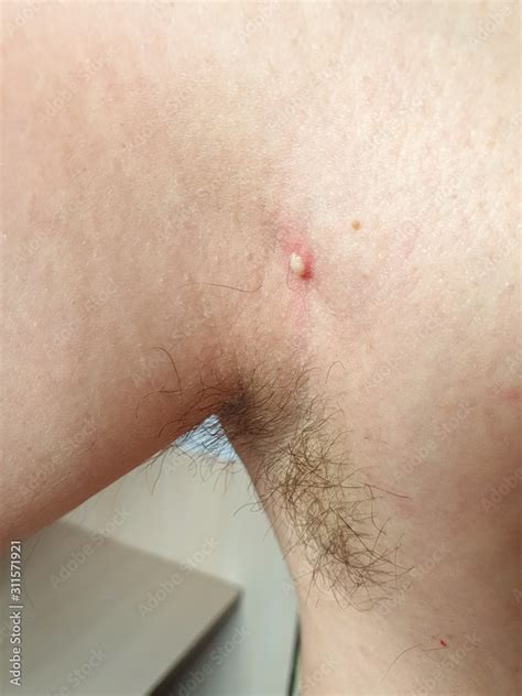Giant Abscess