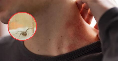 Casos Por Mordedura De Araña Incrementan En Verano Y Afectan Más A Niños Y Adultos Mayores