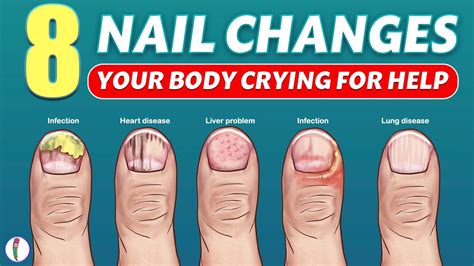 Nail Signs Of Disease Nail Pitting Finger Clubbing Signs Of Anemia Terrys Nails Youtube