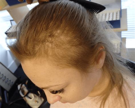 Diffuse Thinning Causes Symptoms Treatment The Hair Loss Centre
