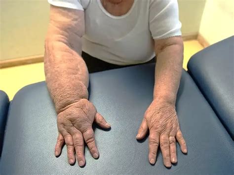 Lymphedema Treatment Romatem