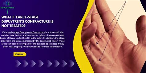 What If Early Stage Dupuytrens Contracture Is Not Treated Pdf