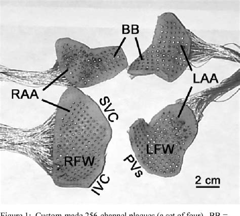 Figure 1 From Feature Extraction Of The Atrial Fibrillation Signal