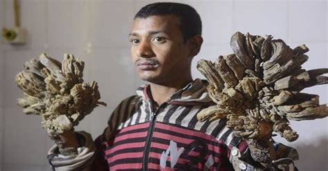 Tree Man Syndrome Is One Of The Rarest Diseases On Earth