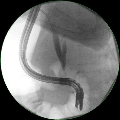 Endoscopic Retrograde Cholangiopancreatography Image Showing Severe