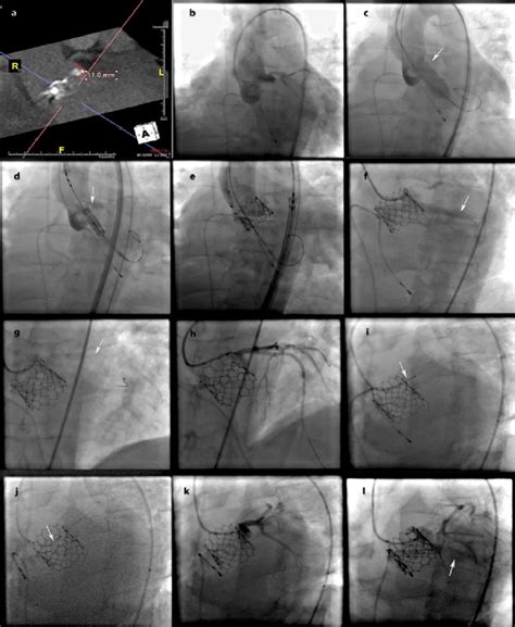 Computed Tomography Ct And Fluoroscopy Images A Ct Depicting Low