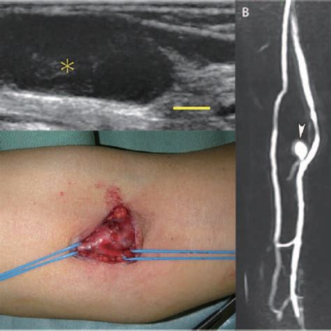 Duplex Ultrasonogram Magnetic Resonance Imaging Mri And