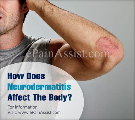 How Does Neurodermatitis Affect The Body And What Triggers It