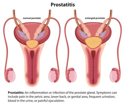 Infografía Sobre Prostatitis Masculina Comprensión De La Enfermedad