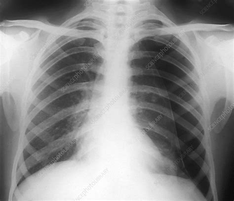 Pneumothorax X Ray Stock Image M2400471 Science Photo Library