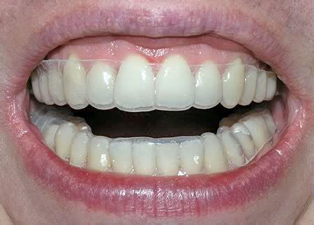 Essix Retainers Devonshire House Denture Solutions Ltd