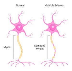 Early Symptoms Of Multiple Sclerosis In Women You Need To Know Swiss Medica