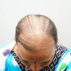 Alopecia Urban Skin And Hair Clinic