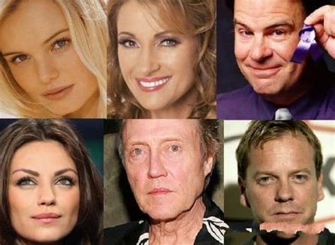Celebrities With Deformities