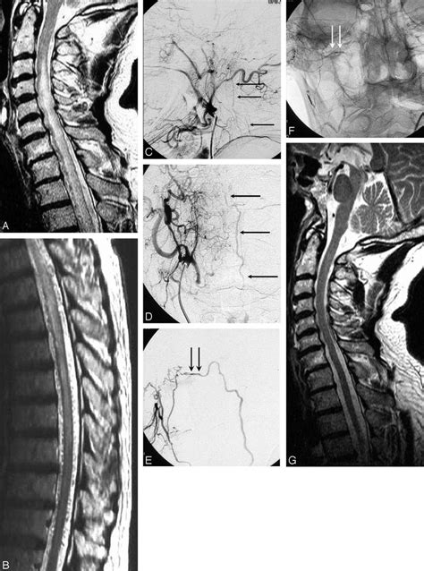 A 65 Year Old Man With Progressive Cord Dysfunction A And B Mr Image