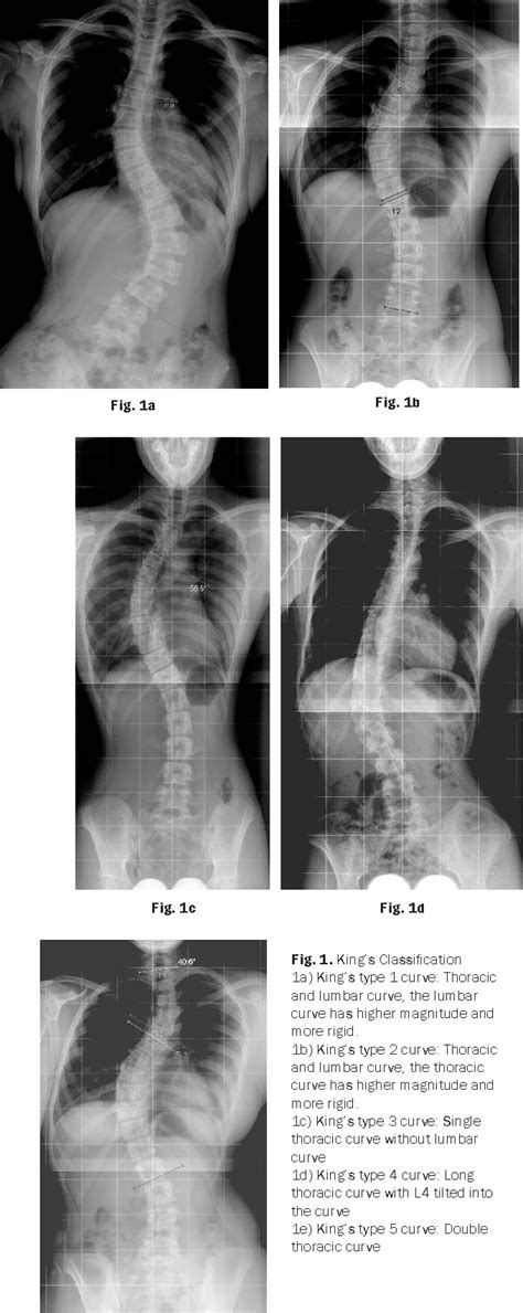 Adolescent Scoliosis Classification And Treatment Wheceg