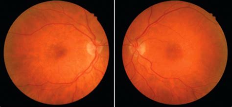 Study Identifies Potential Markers Of Amd Progression From Early To Intermediate