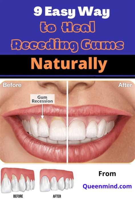 Easy Ways To Heal Receding Gums Naturally QueenMind