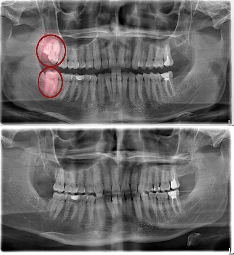 What To Do After Wisdom Tooth Extraction Ormeau Dental