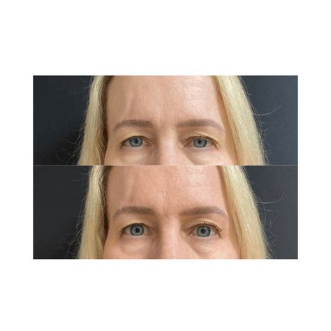 Oxymetazoline Side Effects On Skin