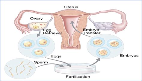 Embryo Transfer Procedure For In Vitro Fertilization Ivf Gkaaln