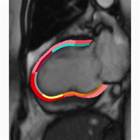 Video Medis Medical Imaging On Linkedin Longitudinal Regional Strain Vs Inward Displacement
