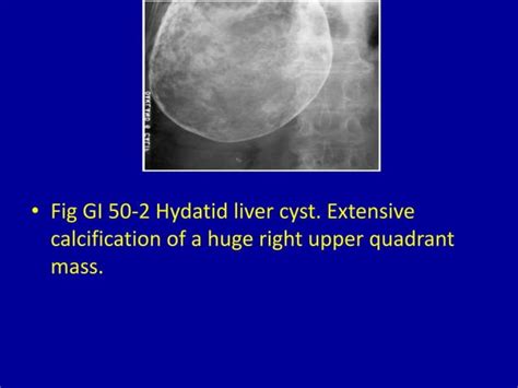 50 Liver Calcification Pptx Medical Health