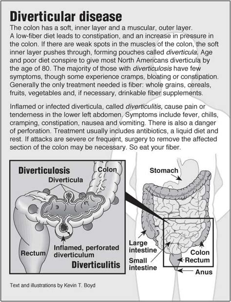 Bleeding Diverticulitis Symptoms Diverticular Disease Symptoms