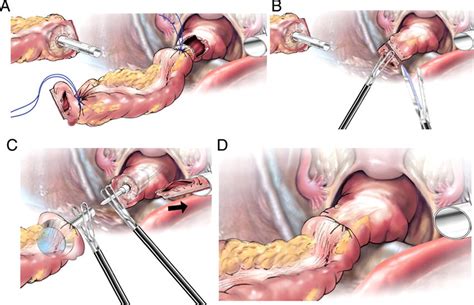 Technique For Full Laparoscopic Sigmoid Resection A After Complete Download Scientific