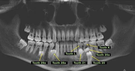 Supernumerary Teeth Mesiodens