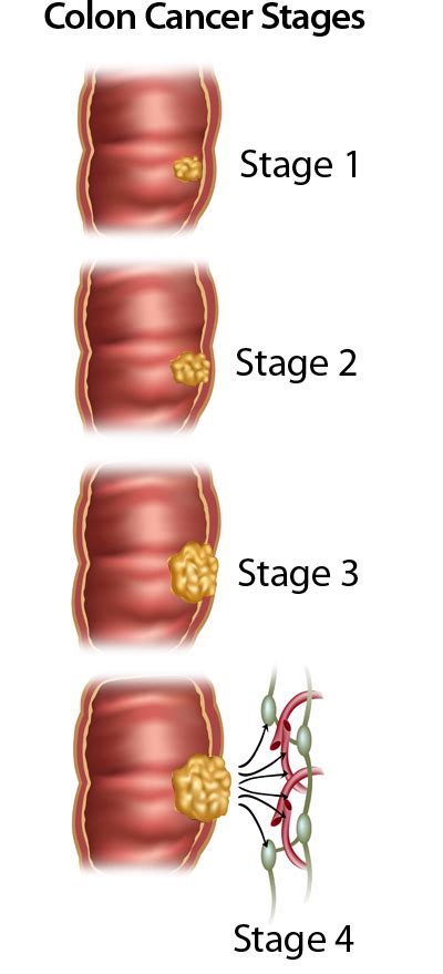 Cecum Ascending Colon Cancer