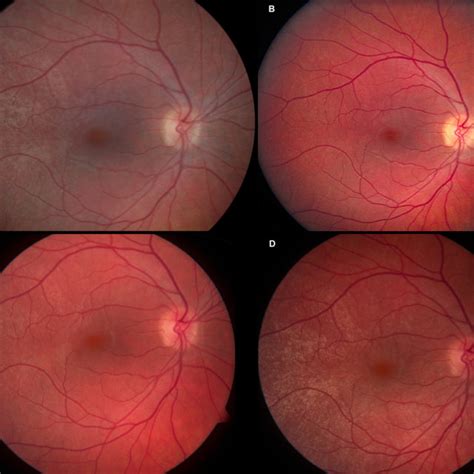 The Development Of Lesions In Multifocal Pattern Dystrophy A