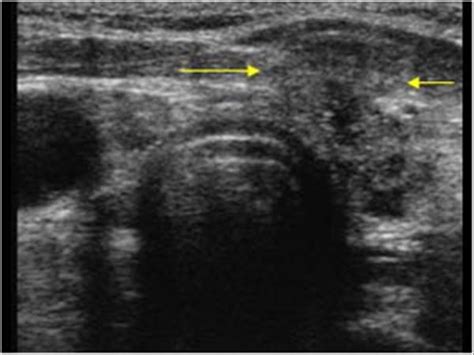Head And Neck 41 Thyroid Gland Case 413 Thyroid Malignant