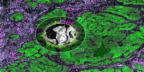 Insights From Spatial Transcriptomics On Organ Transplantation