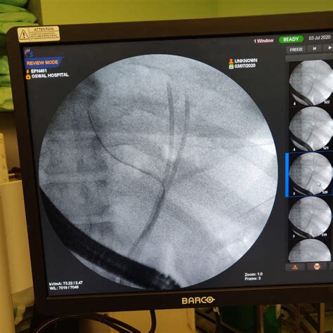 Triplewire Plasticstents Ercp Dr Kartik Goyal