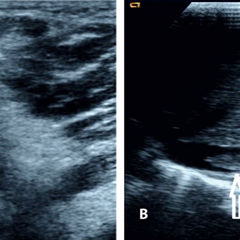 Ultrasound Image Showing A Echogenic Thrombus Arrow In The