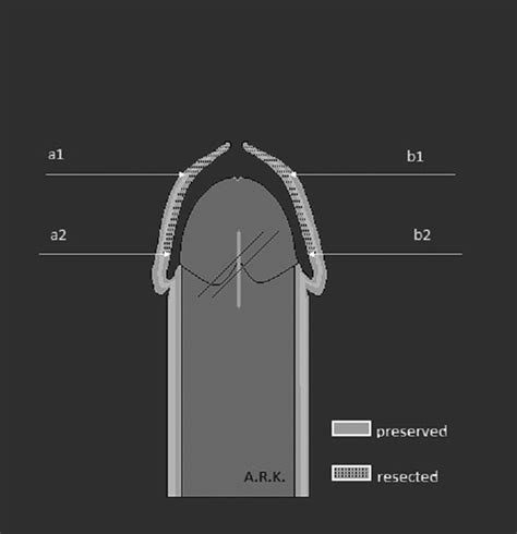 Circumcision A New Approach For A Different Cosmetic Result PMC
