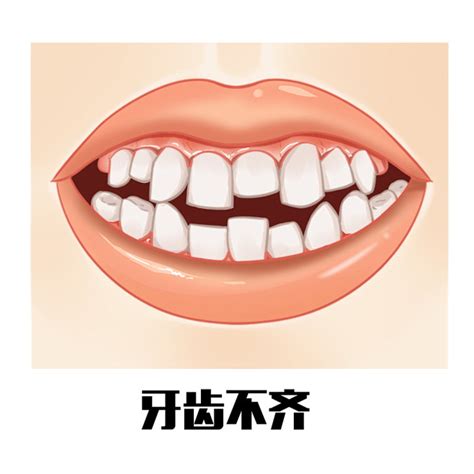 牙齿 口腔 漫画 插画 卡通 牙齿矫正 牙齿疾病 牙齿稀疏 牙齿错乱 反颌 牙列拥挤 中线不齐 开颌 牙齿缺损 深覆合 龅牙 牙齿不齐 偏颌 虎牙 口腔种植 口腔美学正畸 改善龅牙不整齐 对刃