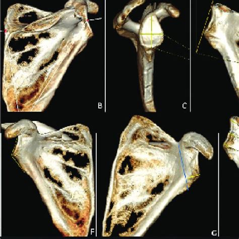 Examples Of Measurement Techniques Of Glenoid Plane And Scapular Plane Download Scientific