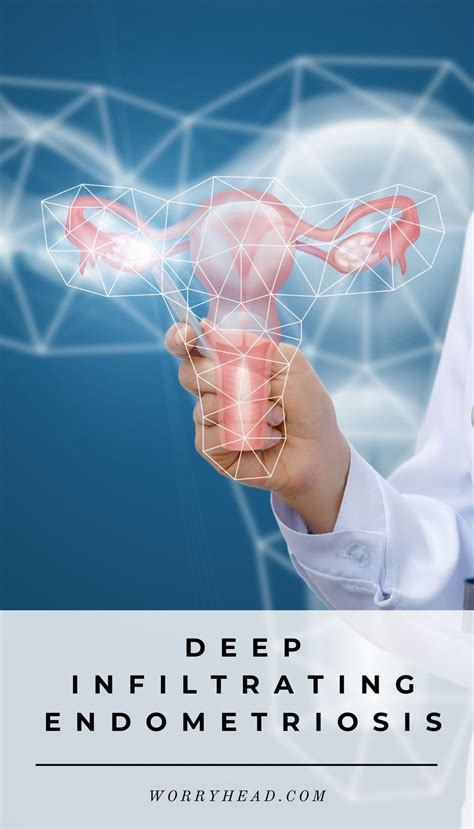 What Is Deep Infiltrating Pelvic Endometriosis Endometriosis Artofit
