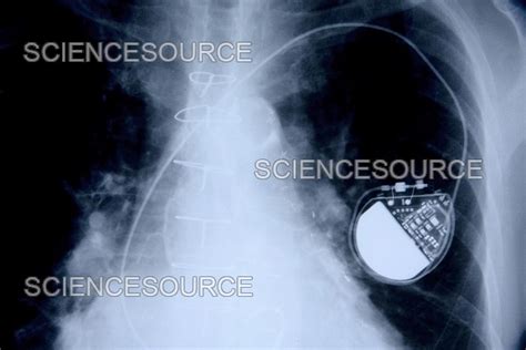 Pacemaker X Ray Stock Image Science Source Images
