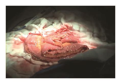 Opened Bowel Segment Along The Antimesenteric Border Download Scientific Diagram