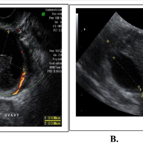 Mayo Endoscopic Subscore Descriptors And Representative Images Mayo 0 A Download Scientific