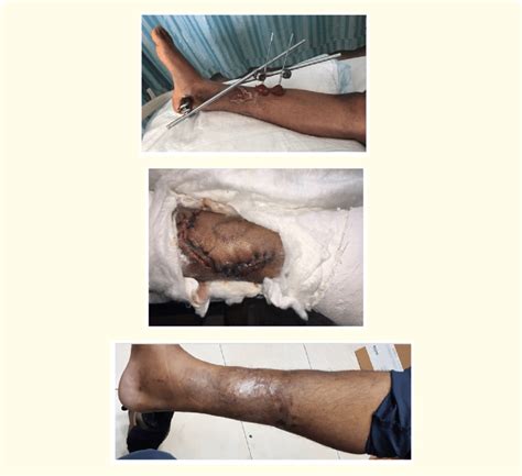 Rotational Flap Used To Cover Wound At Lower Third Of Tibia With