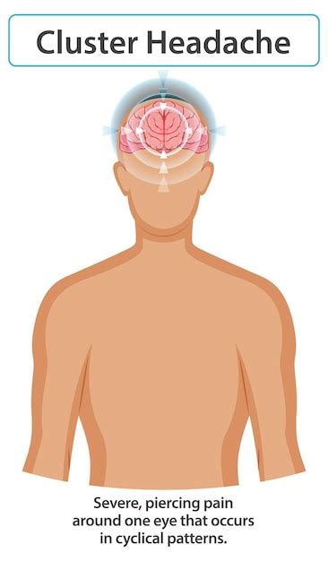 클러스터 두통 과 증상 을 이해 하는 것 무료 벡터