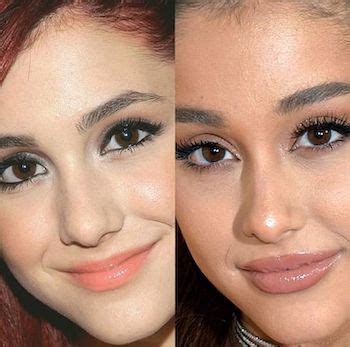 Ariana Grande Lip Injections