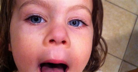 Hives In The Kitchen Band Aid Adhesive And Allergy