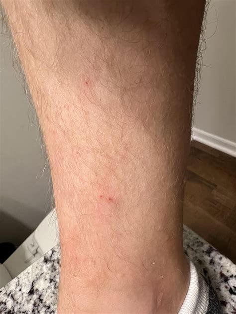 Does This Look Like A Bed Bug Or Scabies Bite R Bugbites