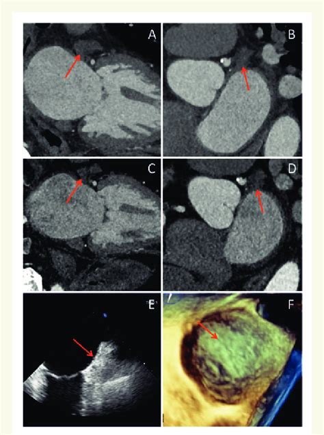 A Follow Up Imaging Showing Stationary Results A And B Six Month