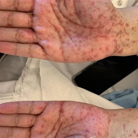 Generalised Maculopapular Rash With Target Lesions On Lower Limbs Download Scientific Diagram